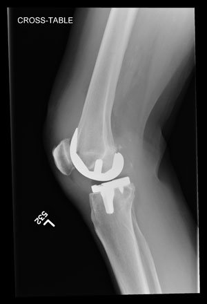 Knee Replacement | Joint Replacement | Henry Ford Health - Detroit, MI