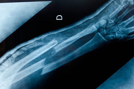 Types of Broken Bones | Orthopedics | Henry Ford Health - Detroit, MI