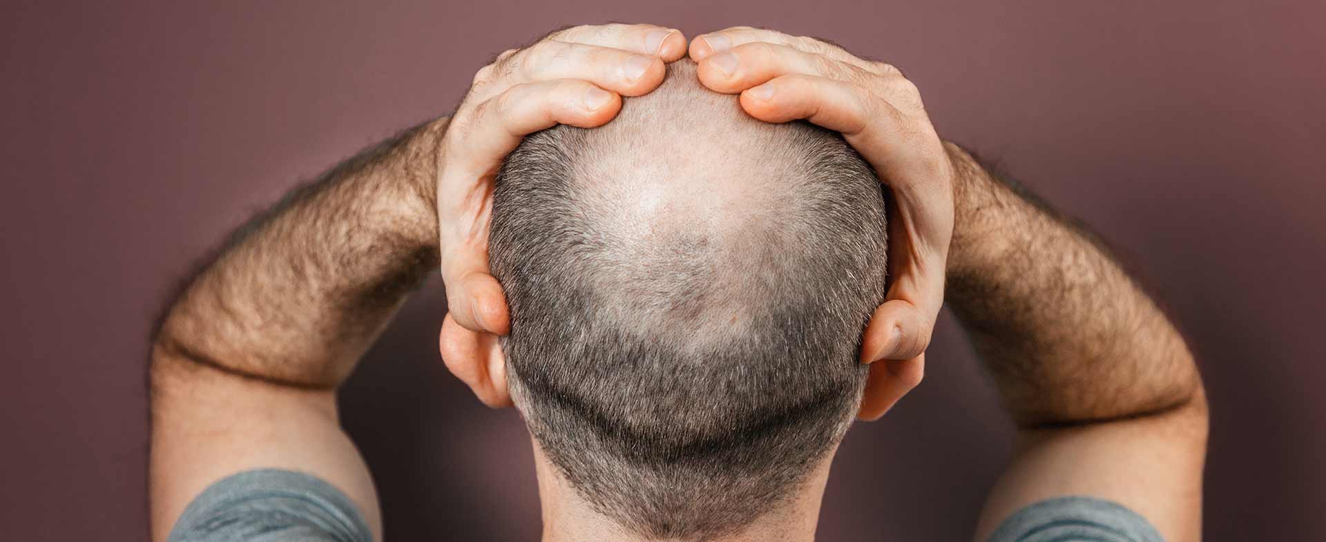 Hair loss men store
