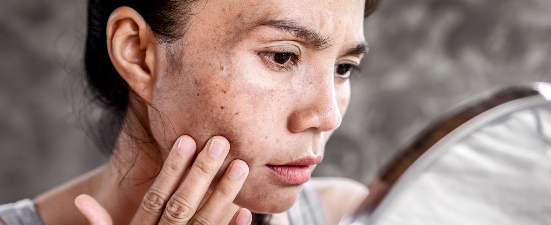 Hyperpigmentation 101: Causes, Treatments And Prevention | Henry Ford ...