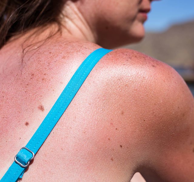 Sunburn Basics: Take The Sting Out Of Sunburn | Henry Ford Health ...