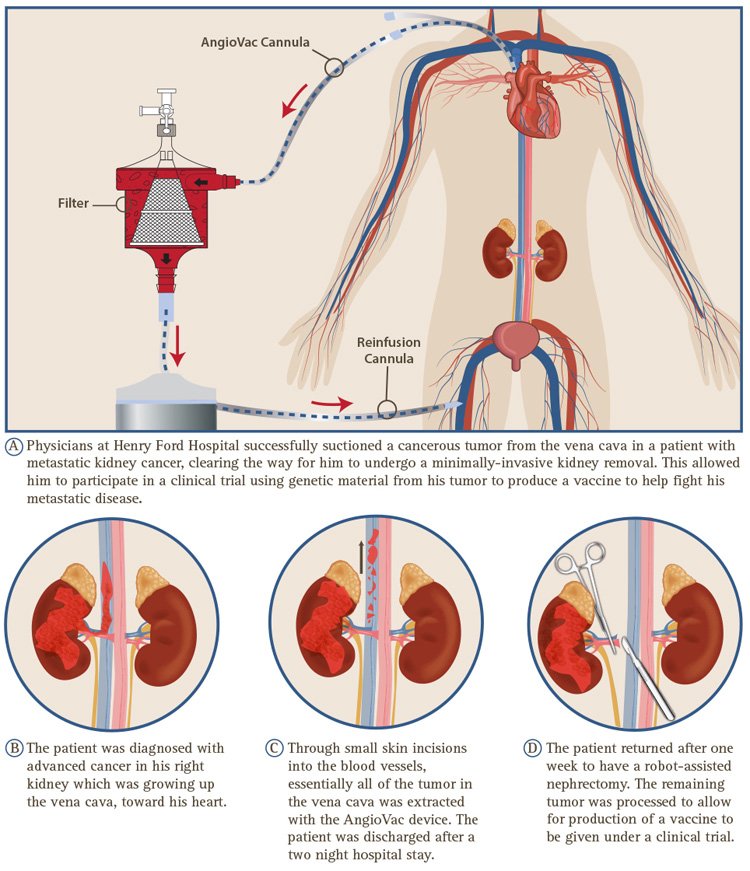 First-in Man: Tumor Suctioned From Vein to Allow for Kidney Surgery ...