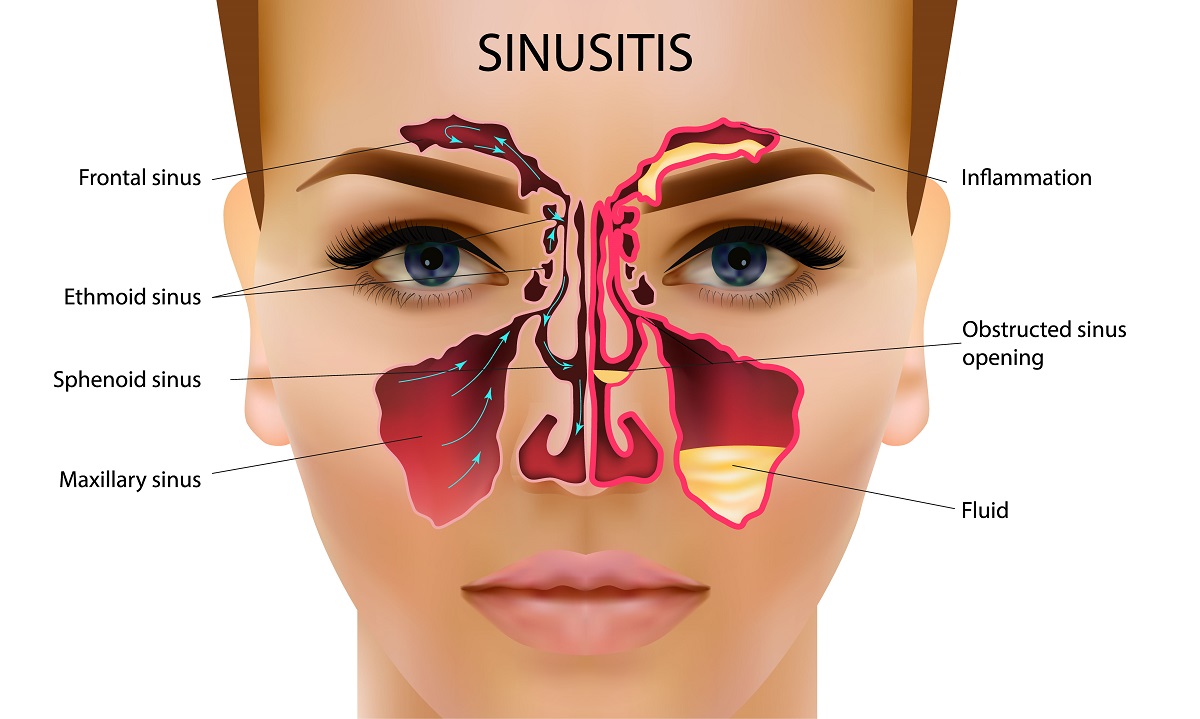 Diagnosing odontogenic sinusitis study | Henry Ford Health - Detroit, MI